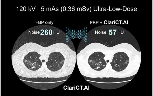 초저선량 CT 이미지 화질 향상 SW로 고품질 영상 생성