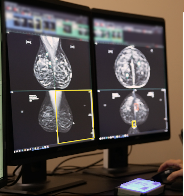GE 유방촬영술 AI 협력 제휴